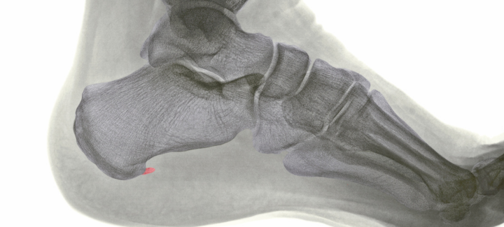 ¿Qué es el Espolón Calcáneo y Cómo Curarlo?